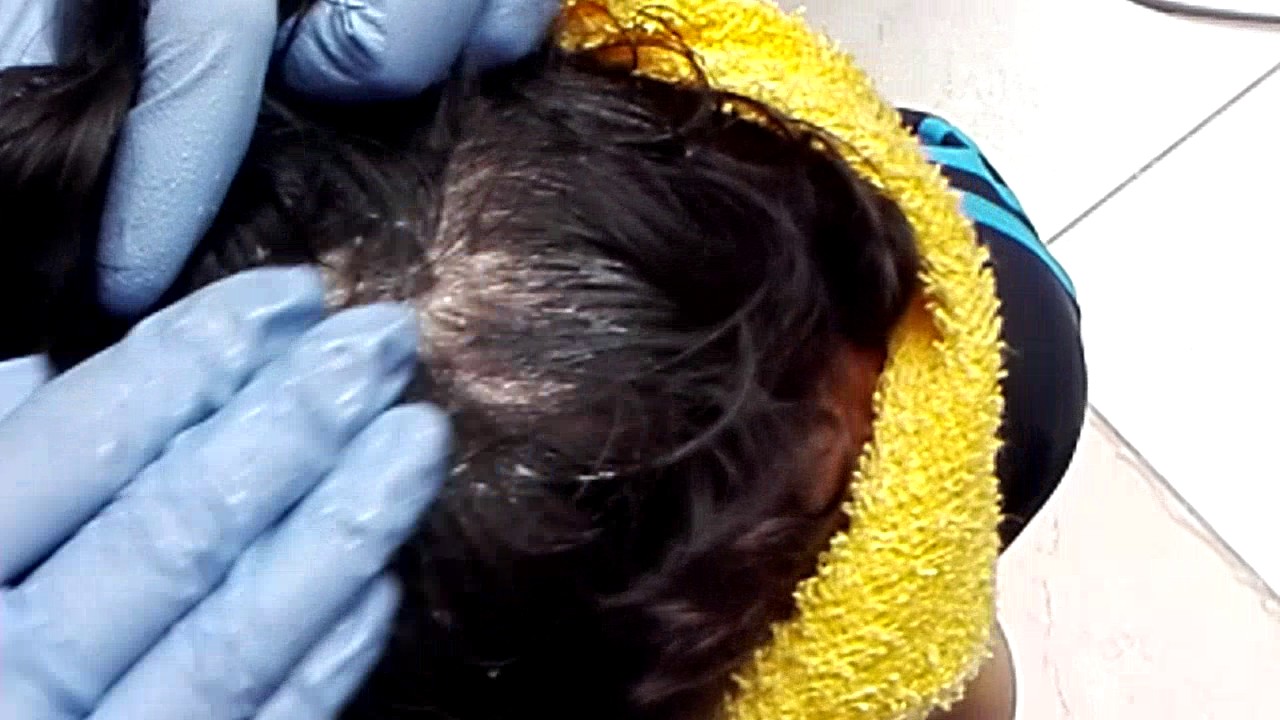 DERMATITIS POR EL SOL Y DERMATITIS POR EL CLORO, DOS FACTORES QUE LA ...